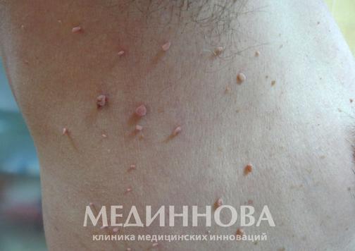 Удаление папиллом в Москве